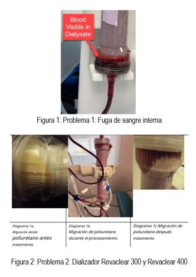 Retiro del mercado de ciertos lotes de los dializadores Revaclear 400 y ...